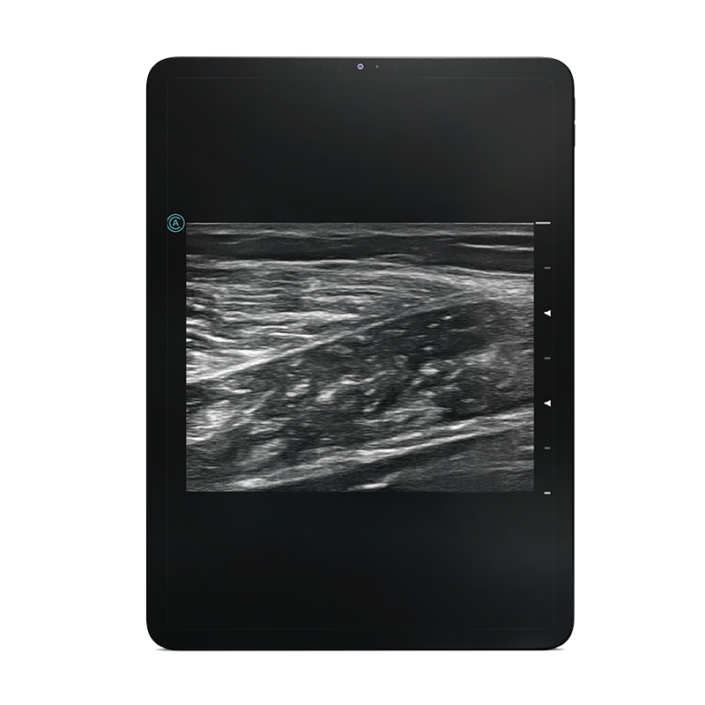 Portable Ultrasound - Apache Ultrasound | Aco Healthcare Co., Ltd.